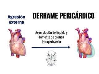 Derrame pericardico y taponamiento cardiaco | PDF