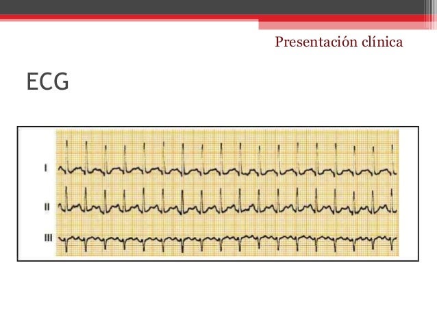 Derrame Pericárdico Ecg