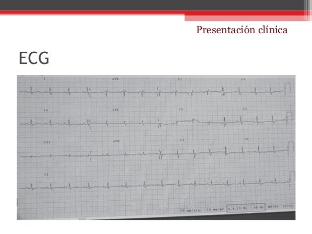 Derrame Pericárdico Ecg
