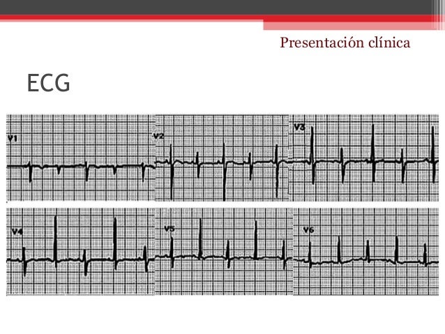 Derrame Pericárdico Ecg