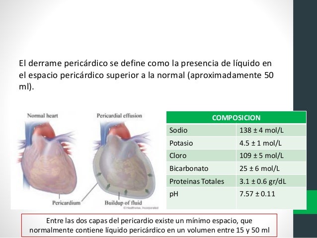 Derrame pericárdico