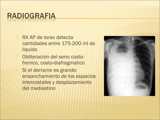 DERRAME PLEURAL | PPT