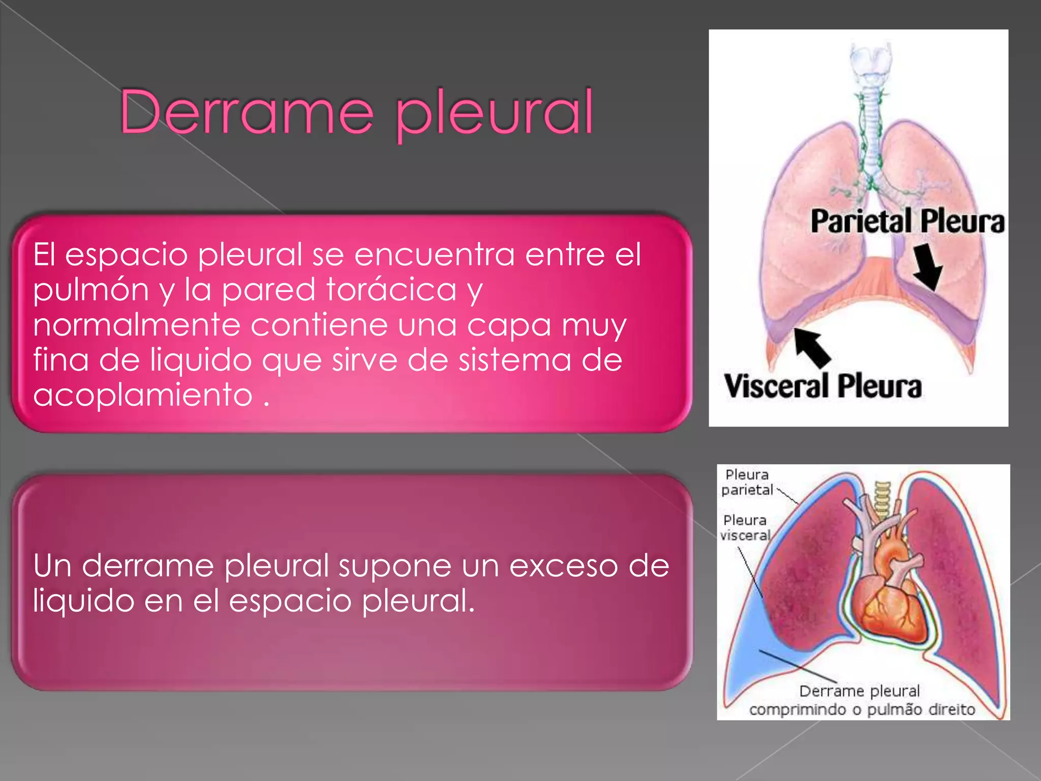 Derrame pleural | PPT