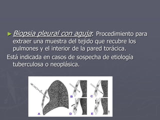 Derrame pleural | PPTX