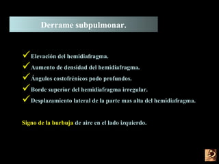 Derrame pleural | PPT