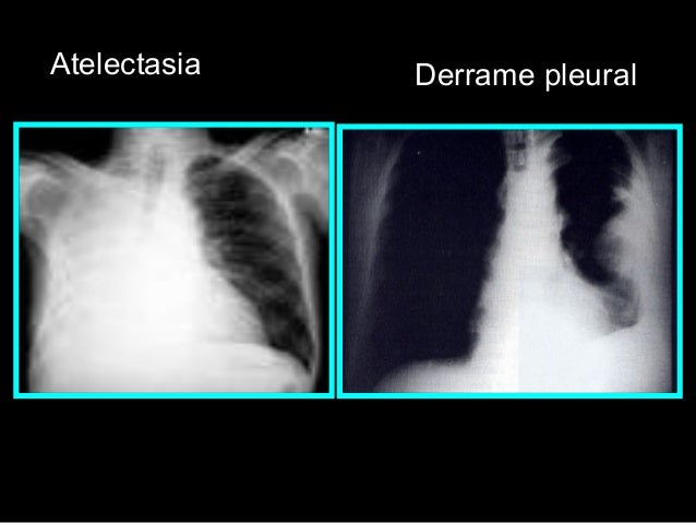 Derrame pleural
