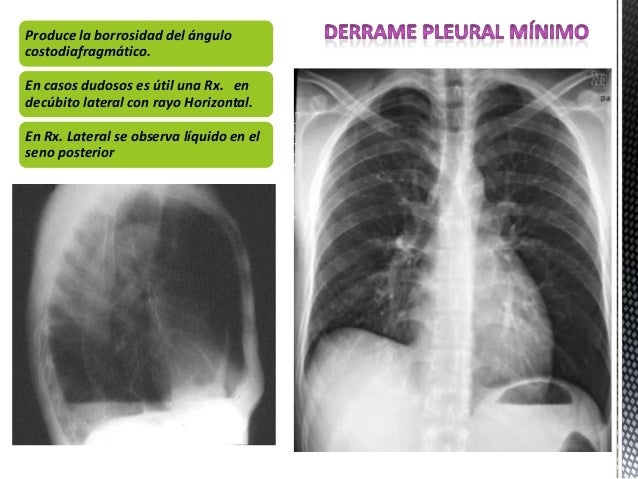 Derrame Pleural Radiografía Lateral
