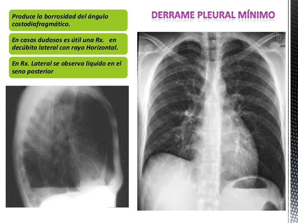 Derrame pleural
