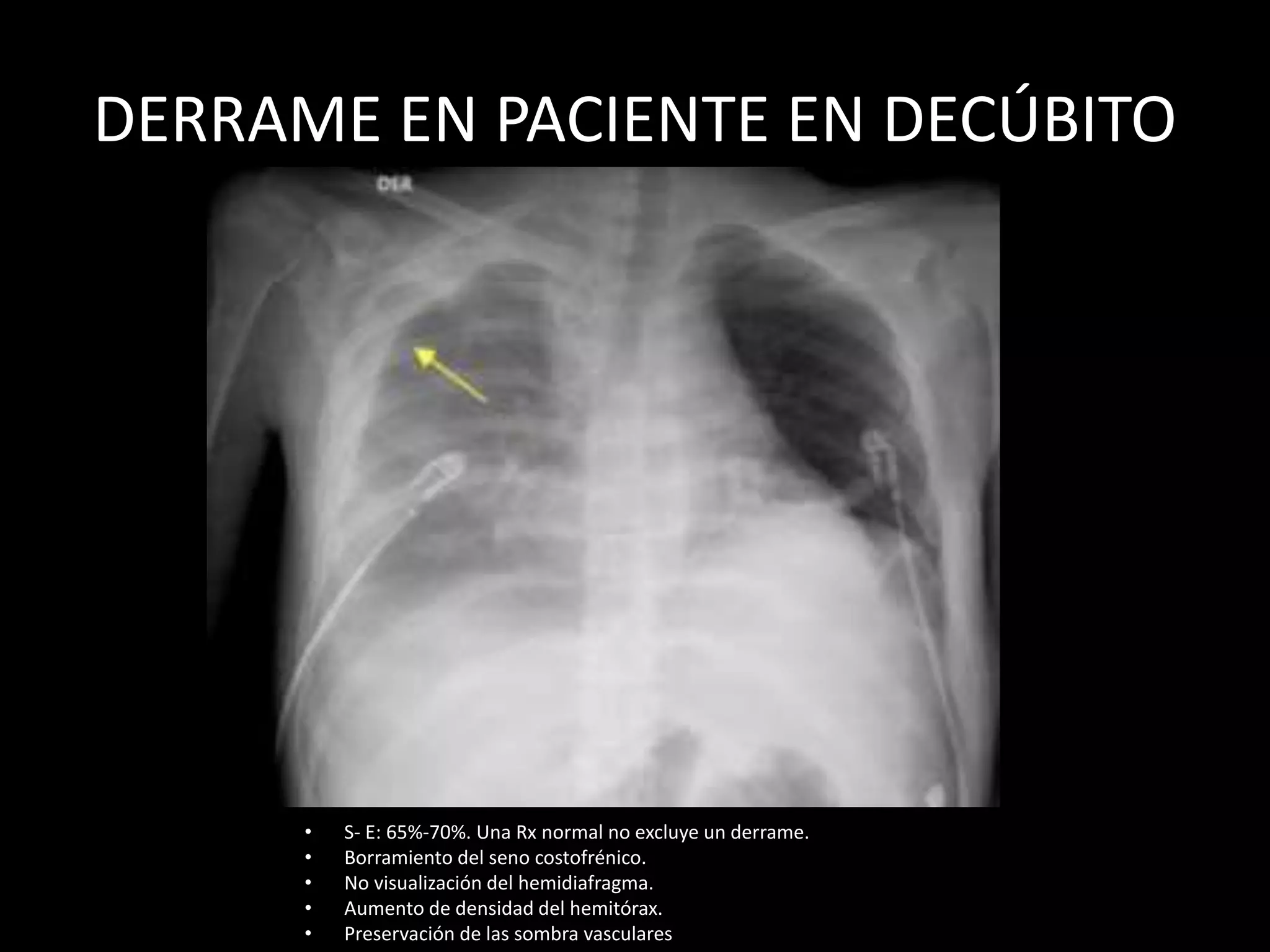 Derrame pleural en radiografía y tomografía. | PPTX