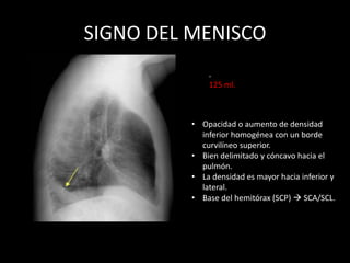 Derrame pleural en radiografía y tomografía. | PPTX