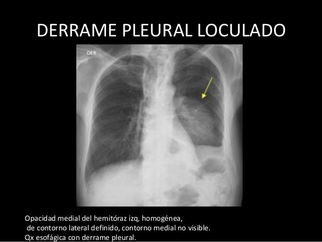 Derrame Pleural Radiografía Lateral