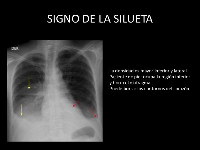Derrame pleural en radiografía y tomografía.