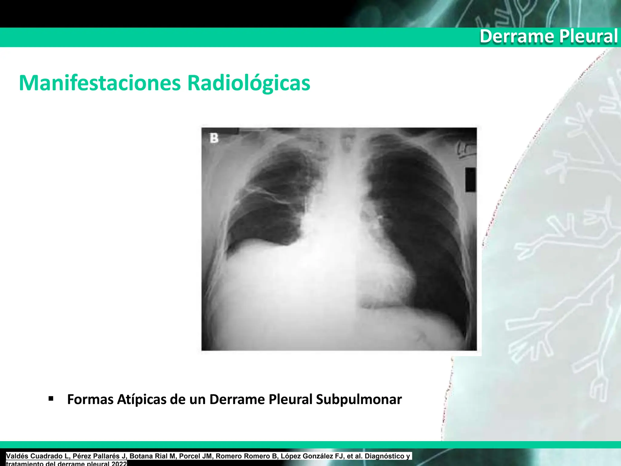 l derrame pleural, conocido popularmente | PPT