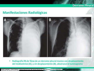 l derrame pleural, conocido popularmente | PPTX