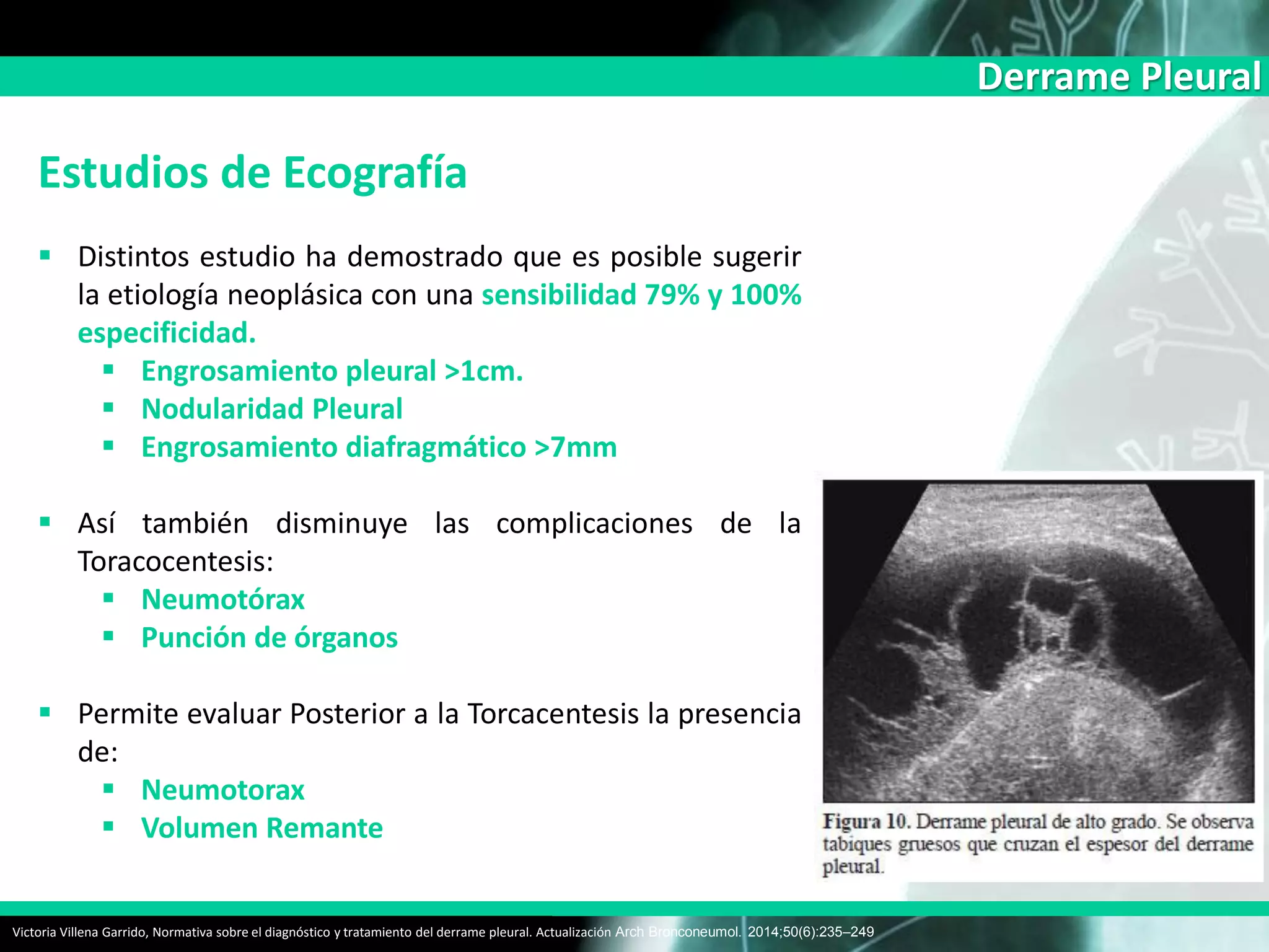 Derrame pleural | PDF