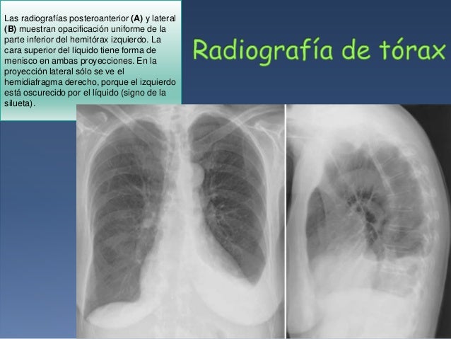 Derrame Pleural Radiografía Lateral