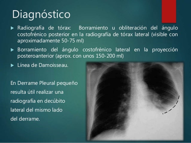 Derrame pleural