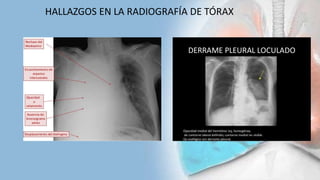 Derrame pleural | PPTX