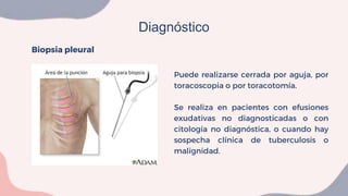 Derrame pleural - Univ. Ana Patricia Bósquez | PPTX