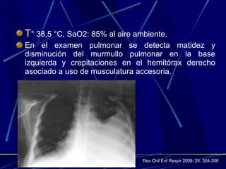 Derrame pleural fisiopatologia | PPT | Blood Disorders | Diseases and ...