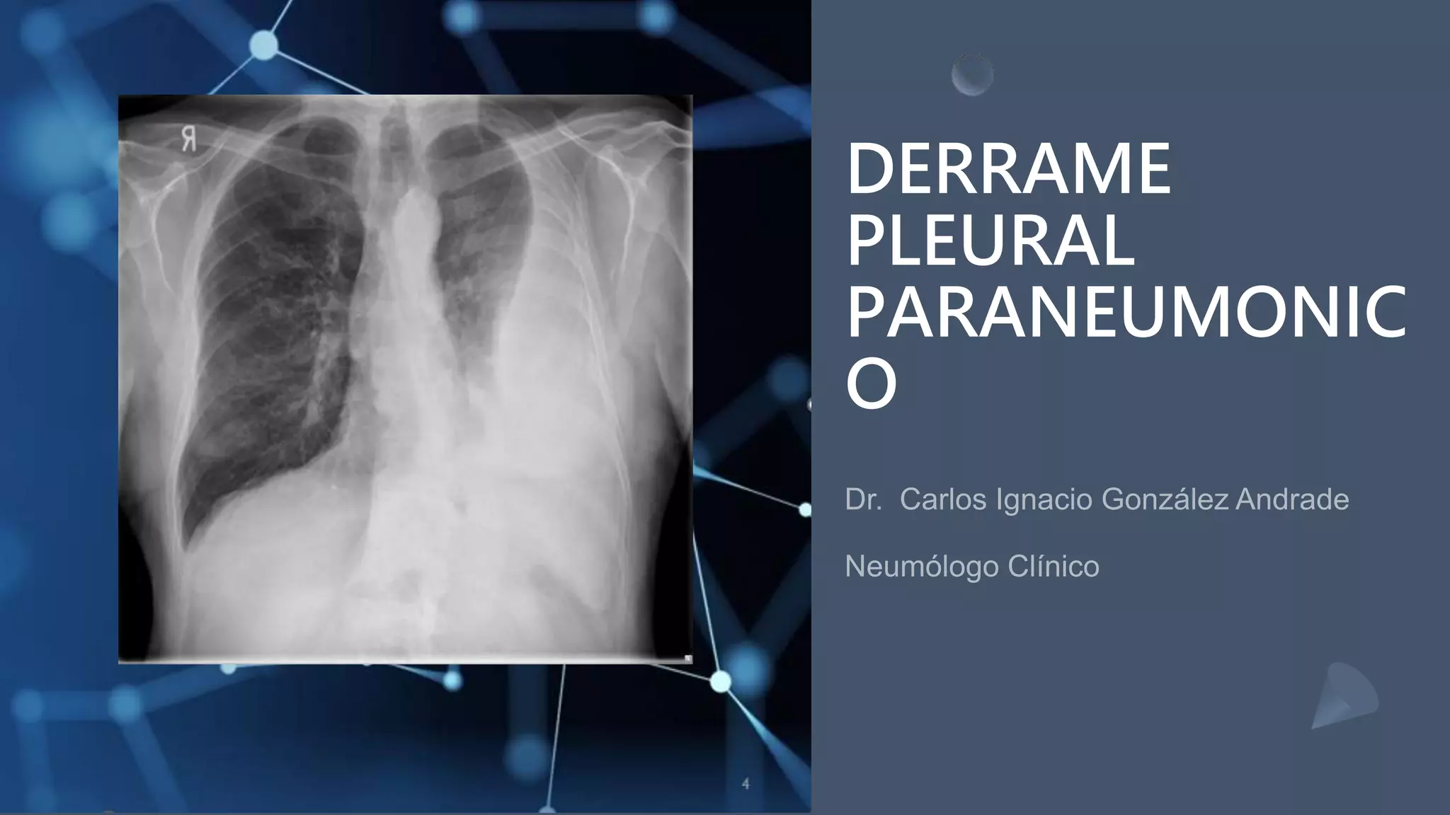 DERRAME PLEURAL PARANEUMONICO.pptx