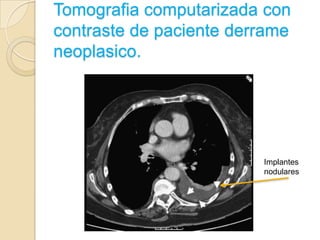 Derrame pleural | PPTX