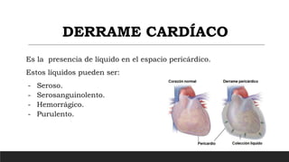 DERRAME PLEURAL Y CARDÍACO (4).pptx