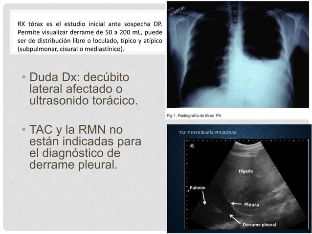 Derrame pleural y neumotorax 2019 by Md Graciela Cordova. UMSS | PPTX