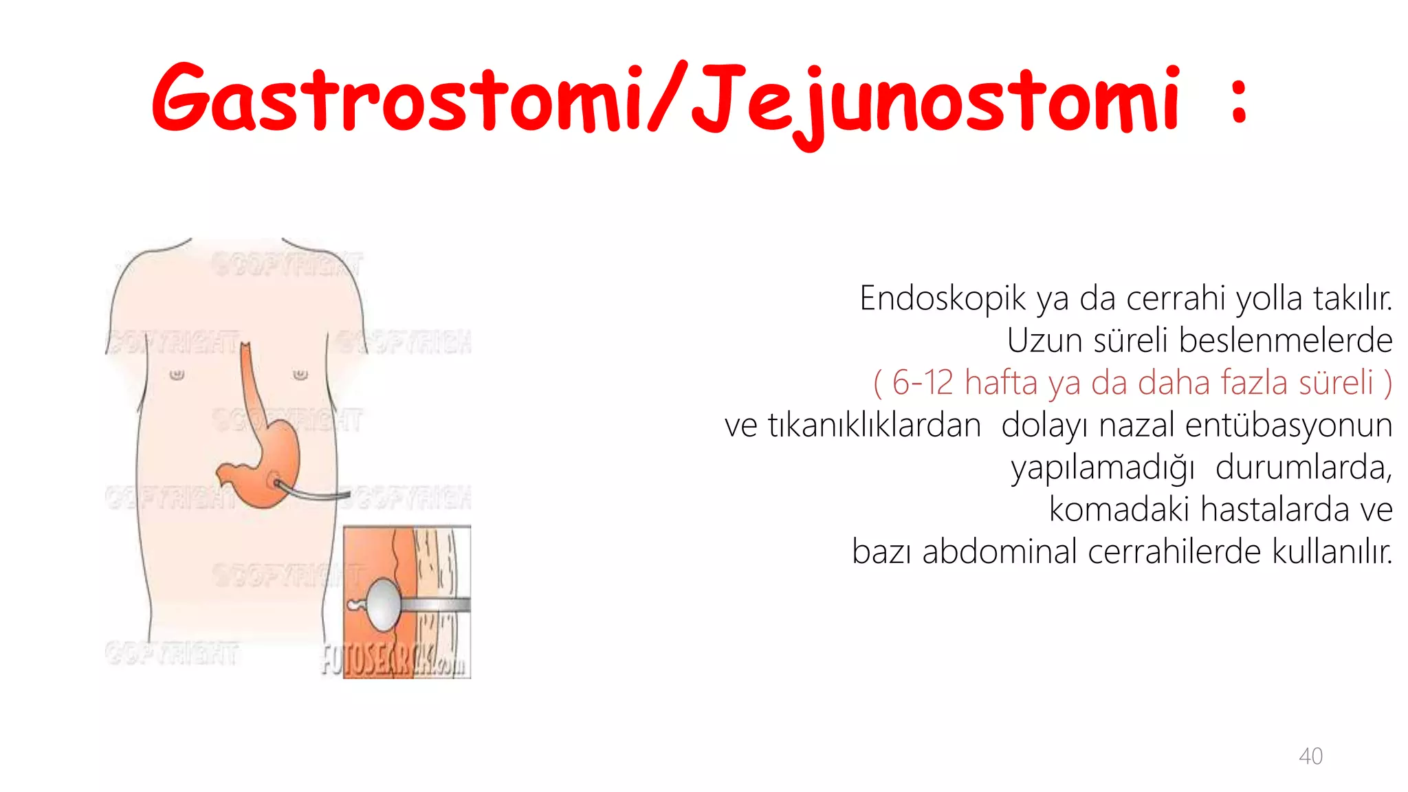 Enteral Beslenme | PPTX