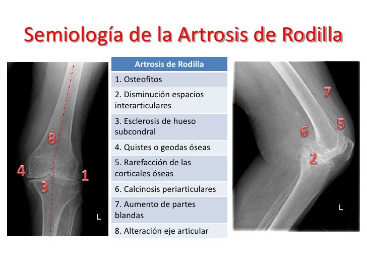 Desafío MIR (44) Artrosis