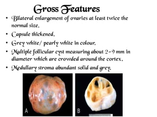 Describe the gross and microscopic features of polycystic ovaries | PPT