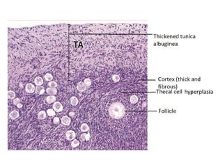 Polycystic Ovary Histology
