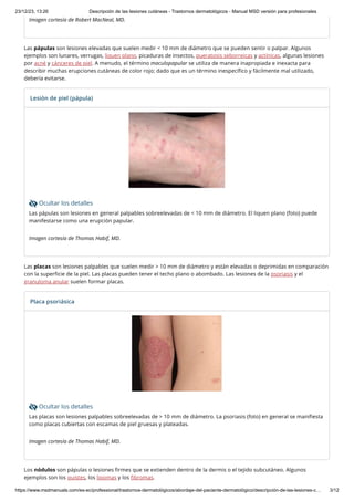 Descripción de las lesiones cutáneas - Trastornos dermatológicos ...