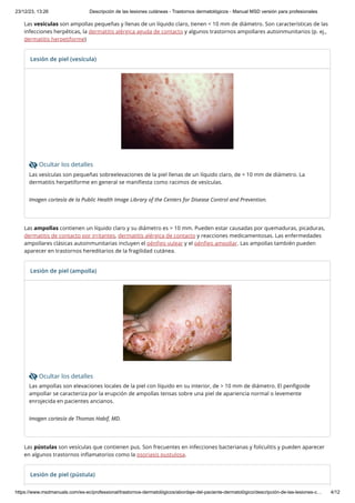 Descripción de las lesiones cutáneas - Trastornos dermatológicos ...