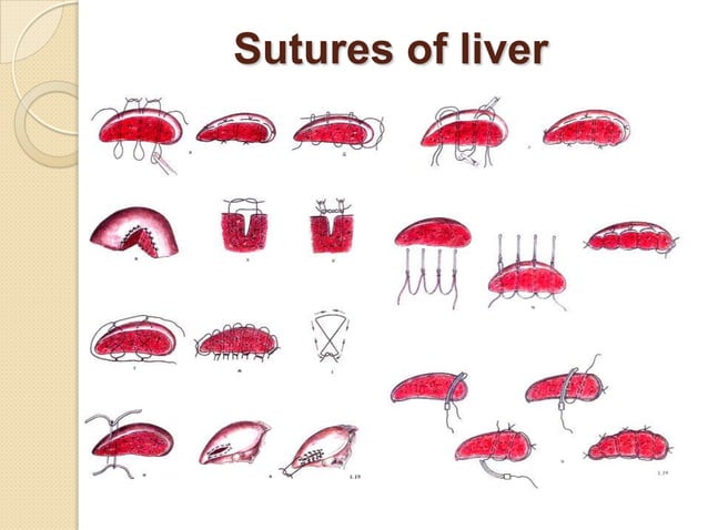 Deseases of the liver | PPT