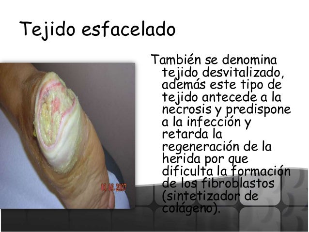 Desfacelado, gangrena y necrosis