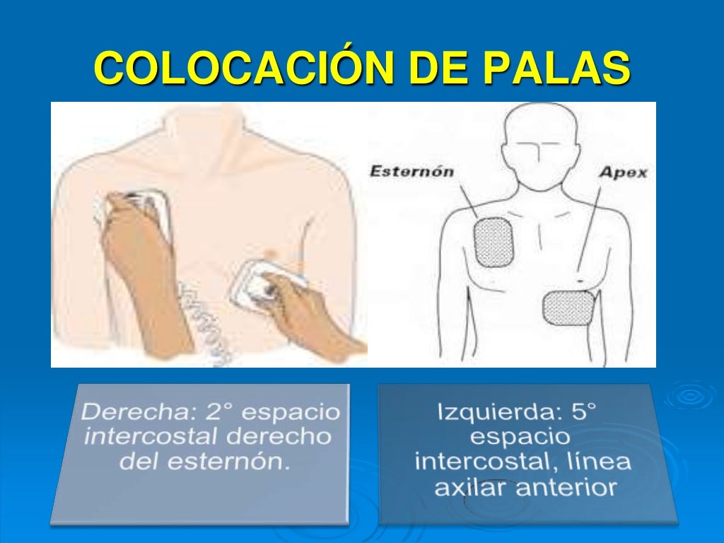 Desfibrilacion