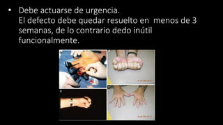 Desguantamiento de dedo por anillo degloving | PPTX