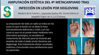 Desguantamiento de dedo por anillo degloving | PPTX