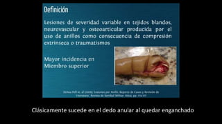 Desguantamiento de dedo por anillo degloving | PPTX