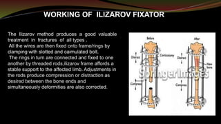 Design and analysis of ilizarov fixator | PPTX