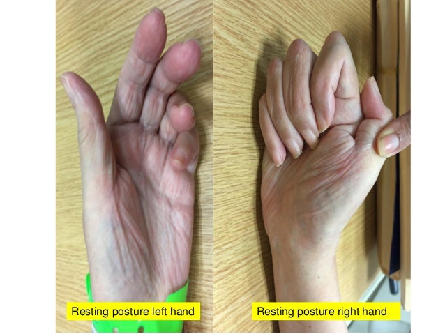 Design and development of a stroke hand service