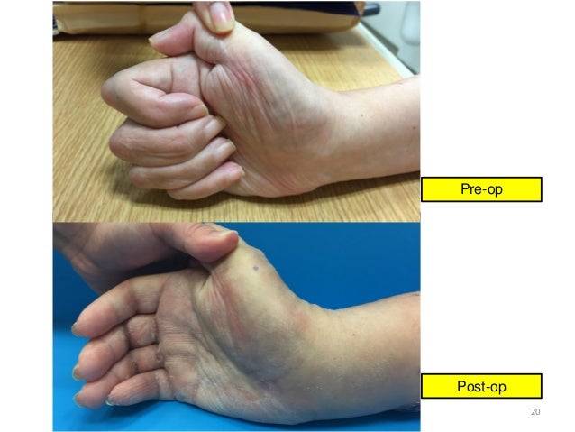 Design and development of a stroke hand service