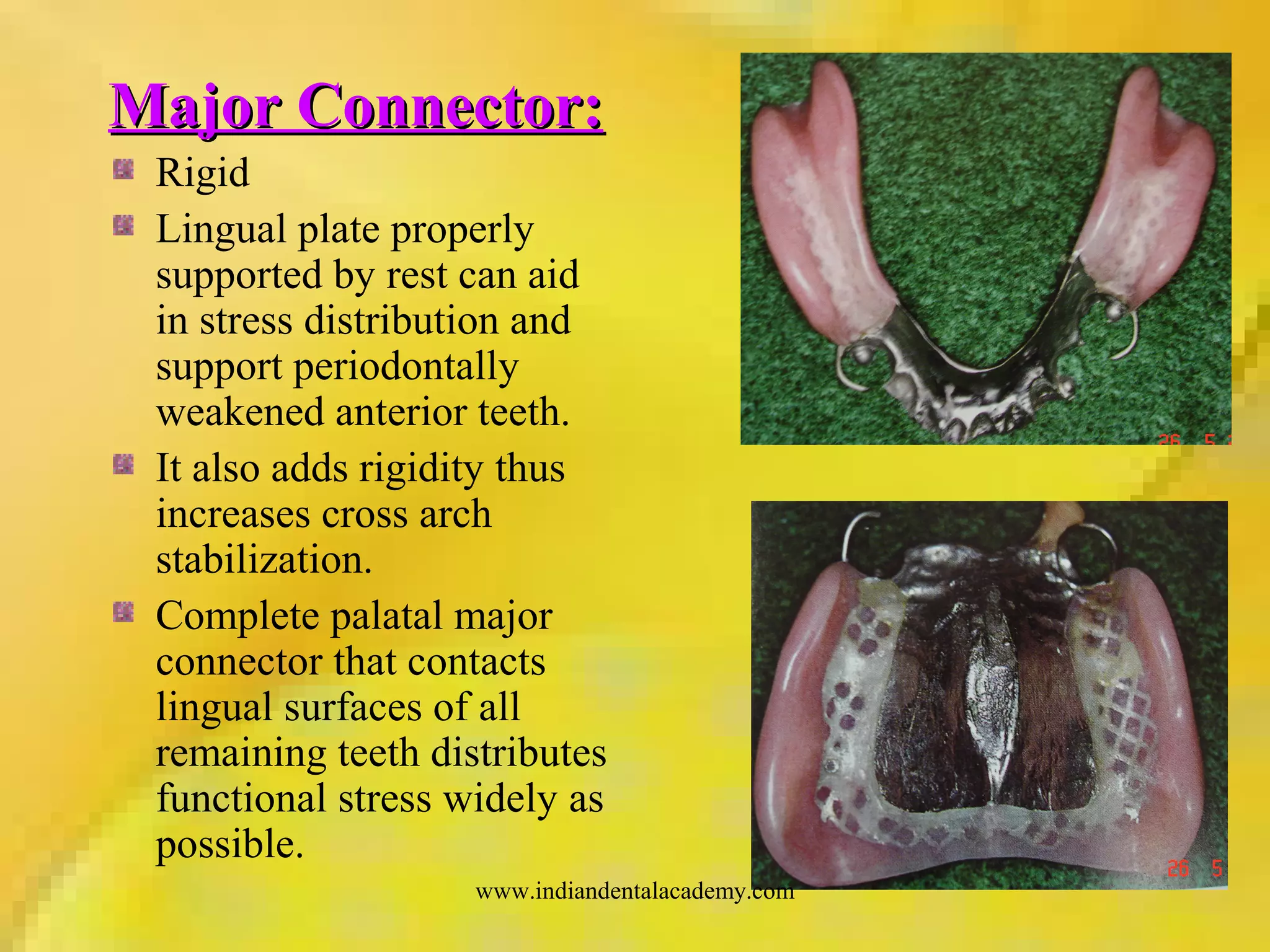 Design consideration in reducing stress in rpd/ oral surgery courses | PPT