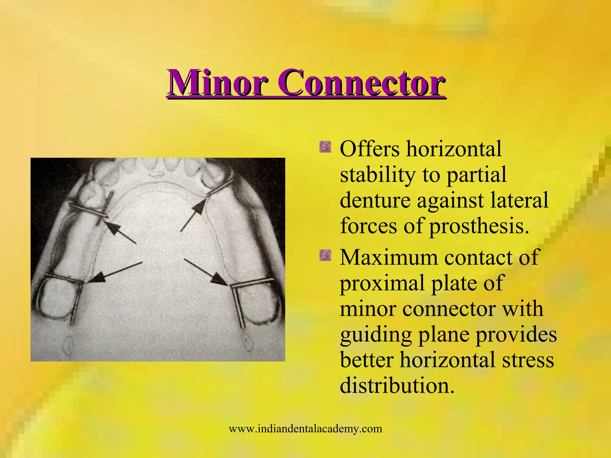 Design consideration in reducing stress in rpd/ oral surgery courses | PPT