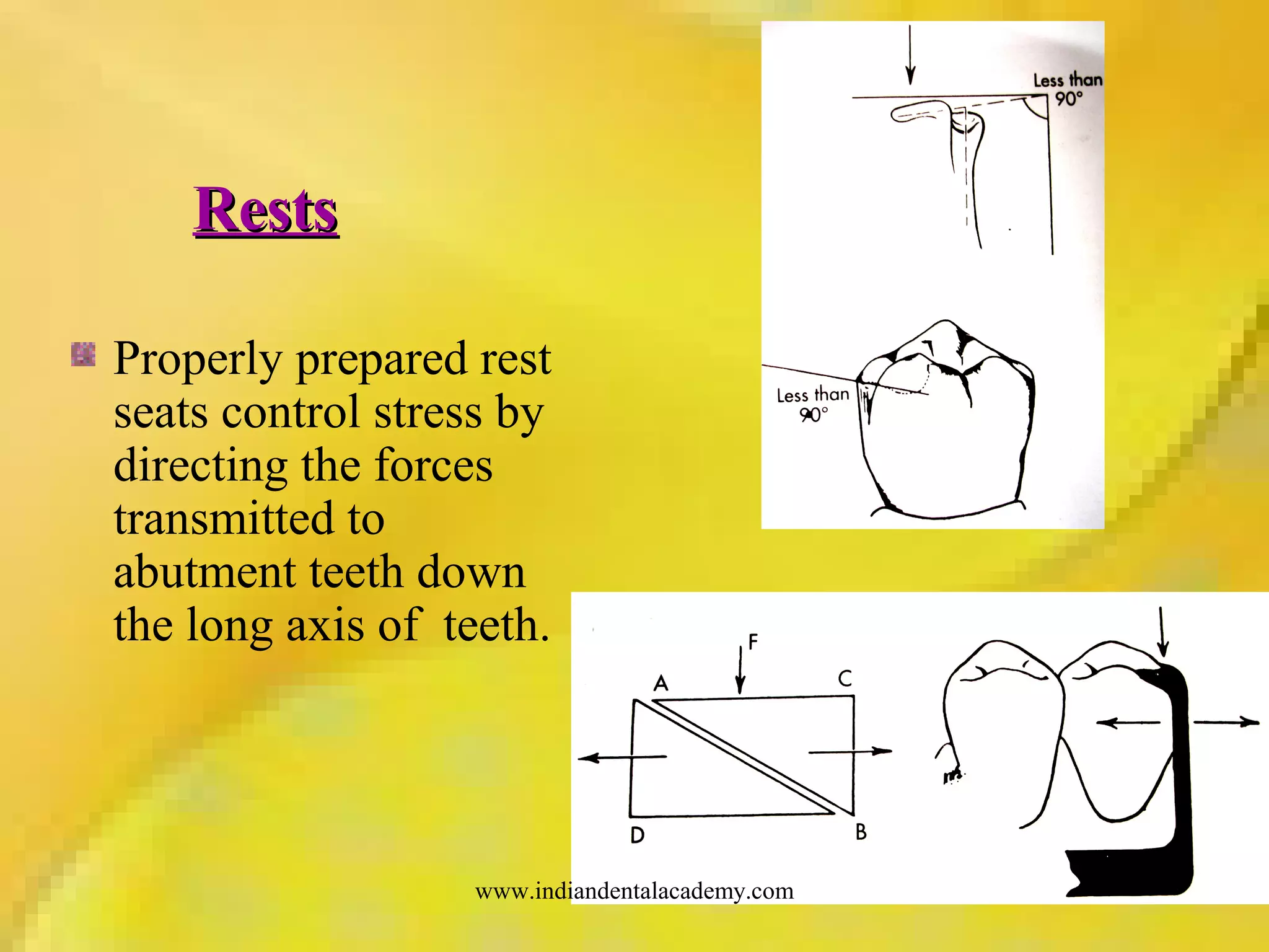 Design consideration in reducing stress in rpd/ oral surgery courses | PPT