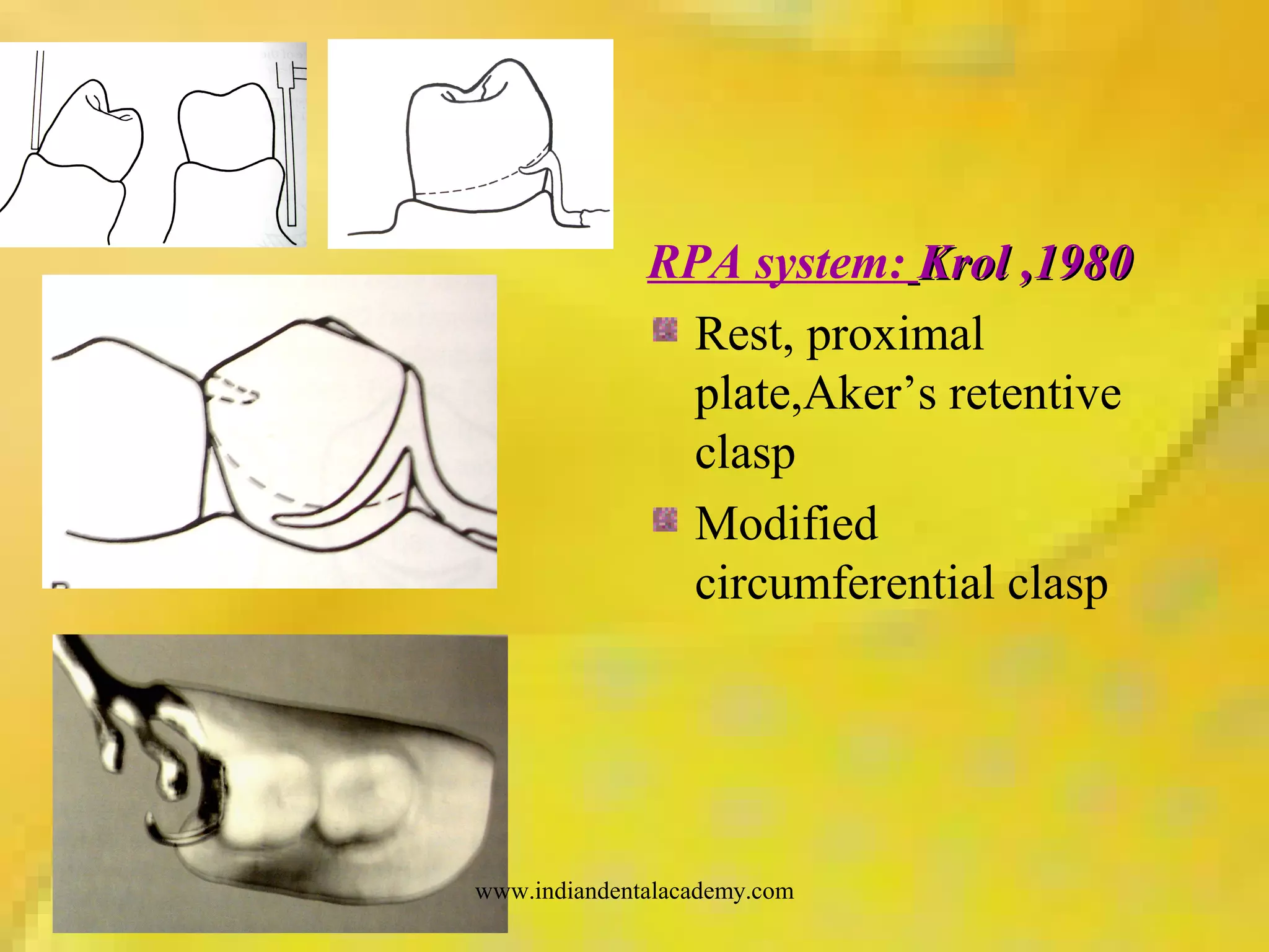 Design consideration in reducing stress in rpd/ oral surgery courses | PPT