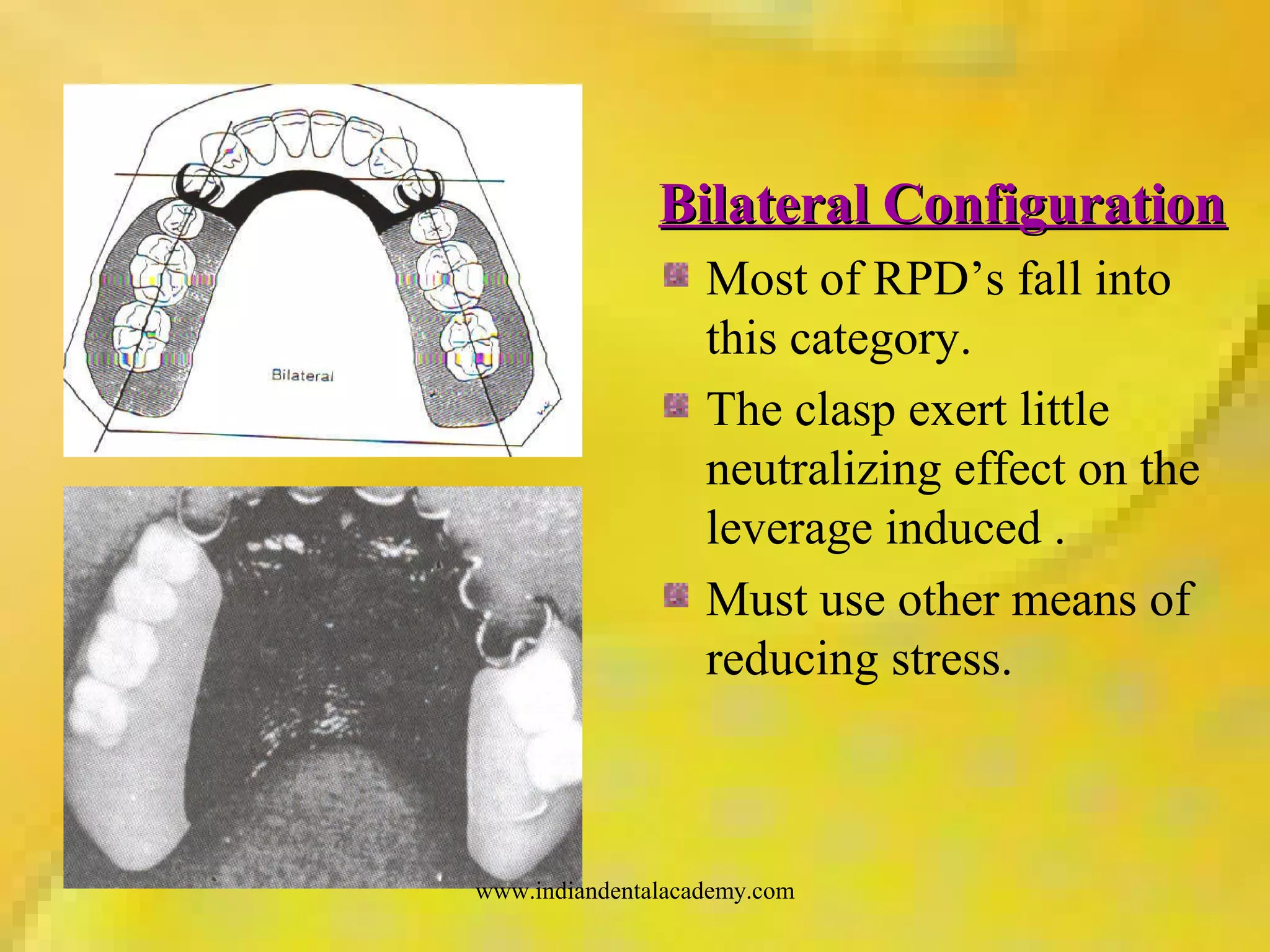 Design consideration in reducing stress in rpd/ oral surgery courses | PPT