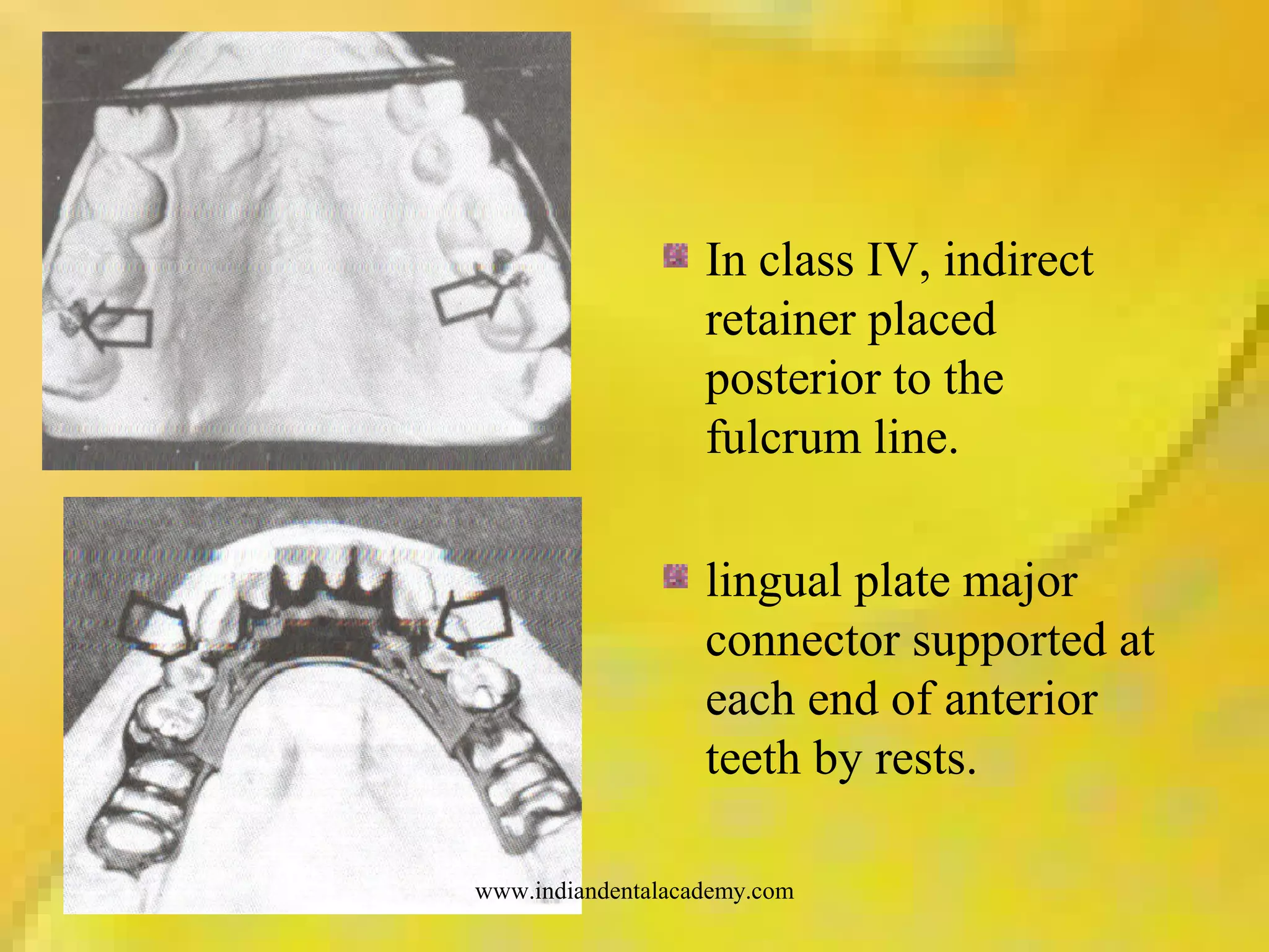 Design consideration in reducing stress in rpd/ oral surgery courses | PPT