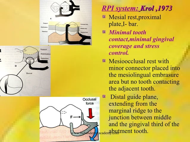 Design consideration in reducing stress in rpd/ oral surgery courses ...